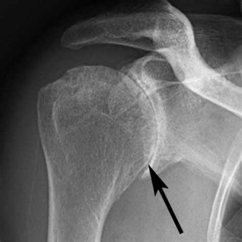 Shoulder Arthritis Treatment In Adelaide Dr Arthur Turow