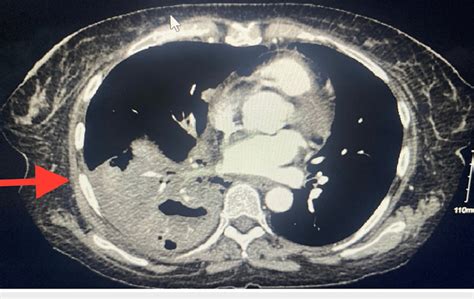 Ct Chest Showing Right Lower Lobe Consolidation With Cavitation Suspect Download Scientific