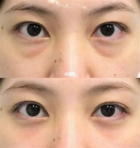 正面侧面都来一下 现在一个月也差不多定型了，素颜也不大看得出来了～要说这个月干啥，家里蹲幸好赶在yi情前噶了 武汉祛眼袋 祛