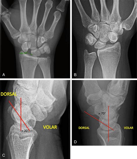 Wrist Instabilities Musculoskeletal Key Wrist Instabilities Musculoskeletal Key