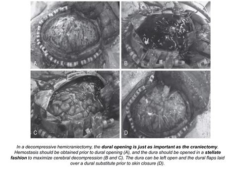 Decompressive Craniectomy Pptx