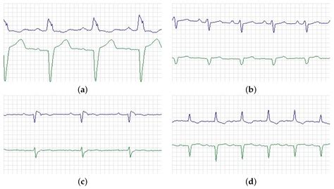 Arrhythmia Classification And Diagnosis Based On Ecg Signal A Multi