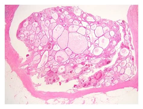 Microscopic Findings For Ovaries A D And The Sigmoid Colon E F Download Scientific