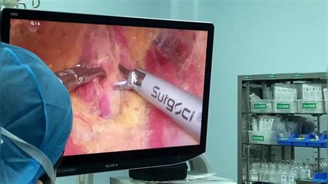 Ultrasonic Scalpel In Use Laparoscopic Bilateral Thyroidectomy Surgsci