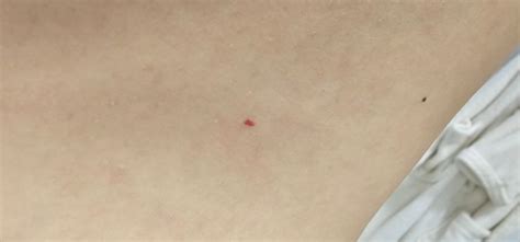 진드기 물린자국 일까요 지식in