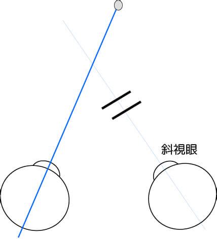 斜視と弱視について専門医の解説やさしい目のクリニック神戸市中央区元町通商店街2024年4月新規開院