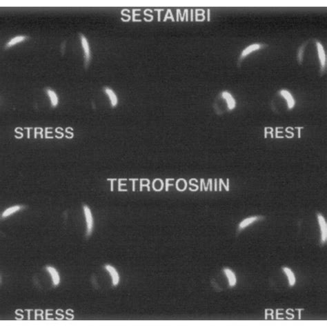 99mtc Labeled Sestamibi And Tetrofosmin Defects Severity At Visual And Download Table