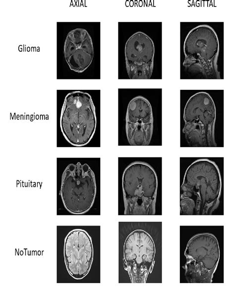 Figure 1 From Classification Of Brain Tumors Using Mri Images Based On