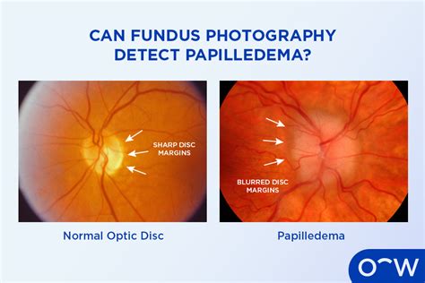 Normal Optic Nerve Vs Papilledema