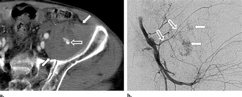 Ct Angiographic Correlation For Detection Of Bleeding From The
