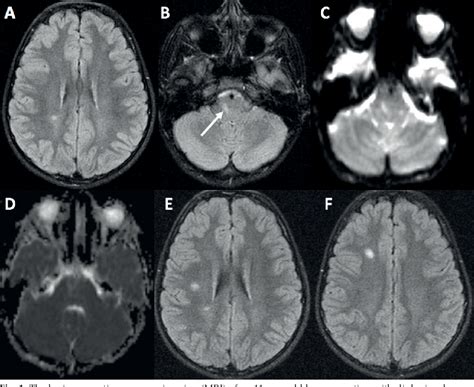 Figure 1 From Clinically Isolated Syndrome And Multiple Sclerosis In