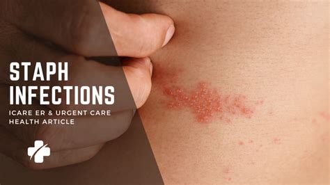 Unmasking Staph Infections Medical Blog Icare