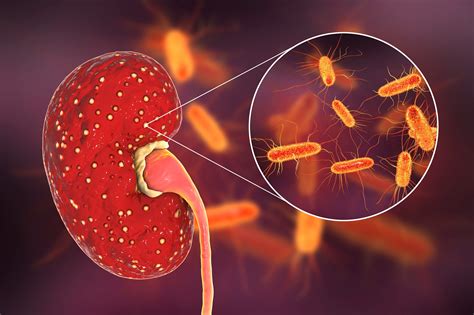 Pyelonephritis Causes Symptoms And Treatment