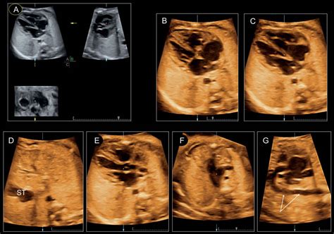 Three And Four Dimensional Ultrasound Of The Fetal Heart Obgyn Key