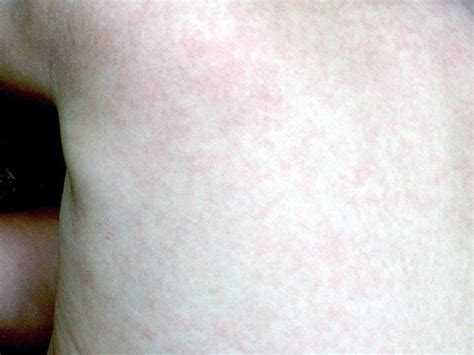 Roseola Sandpaper Rash At Ann Sexton Blog