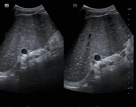 Mohammed Ibrahim Abdalla Ahmed On Linkedin Case 22 Gamna Gandy Bodies Splenic Siderotic