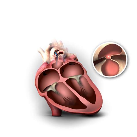 Heart Defect Pda Occlutech Every Beat Counts