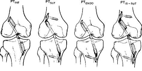 Hamstring Vs Patellar Graft Acl At Willis Beane Blog