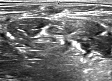 Ultrasound Object Detection Dataset By Longriver