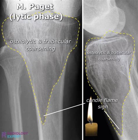 Pathophysiology Of Pagets Disease Of Bone At Elizabeth Knowles Blog