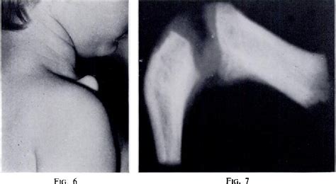 Figure 1 From Congenital Pseudarthrosis Of The Clavicle Semantic Scholar