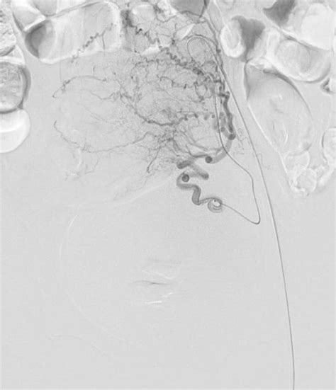 The Filipino Interventional Radiologist