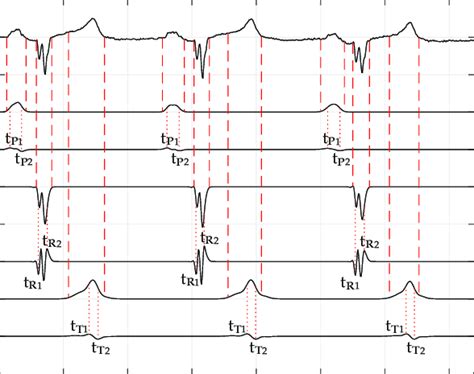 Demonstration Of The Ecg Delineation Method Download Scientific Diagram