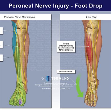 Peroneal Nerve Foot Drop