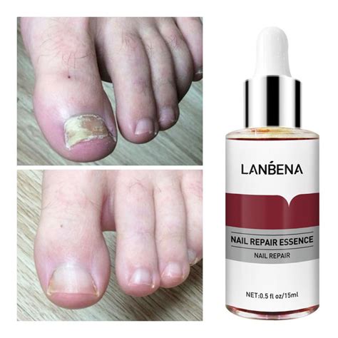 Lanbena Cредство от грибка ногтей на ногах / Уход за ногтями, борьба с ...