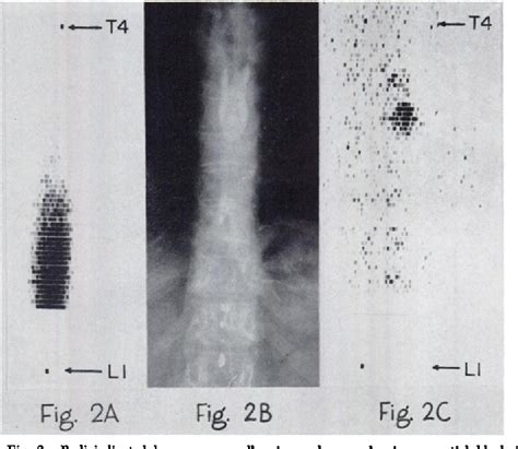 Figure 2 From Scanning Of The Spinal Subarachnoid Space After Intrathecal Injection Of 131i