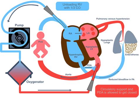 Veno Venous Extracorporeal Membrane Oxygenation In Congenital Download Scientific Diagram
