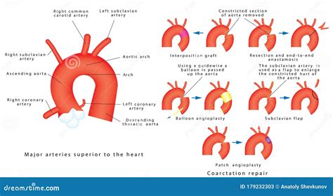 Coarctation Repair Stock Vector Illustration Of Diaphragm 179232303