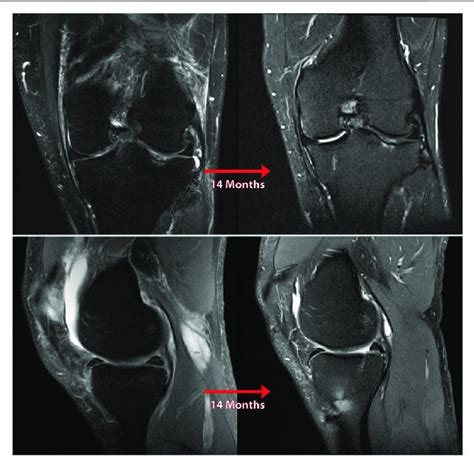 The Hughston Classification Classification Of Posterolateral