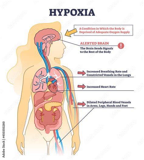 Hypoxia Condition As Lack Of Oxygen In Brain Cells Or Tissues Outline Diagram Labeled Medical
