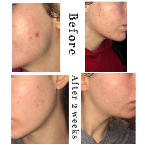250 Best Azelaic Acid Images On Pholder Skincare Addiction Tretinoin