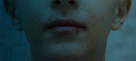 Atopic Dermatitis Challenge Center Mdedge