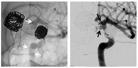 Pipeline Device Aneurysm Selection