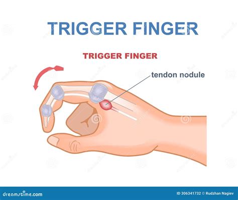 Trigger Finger Vector Concept Stock Illustration Illustration Of Condition Tendon 306341732