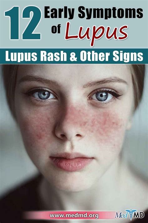 Itchy Rash From Lupus At Ella Gatliff Blog