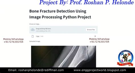 Bone Fracture Detection Using Deep Learning Bone Fracture