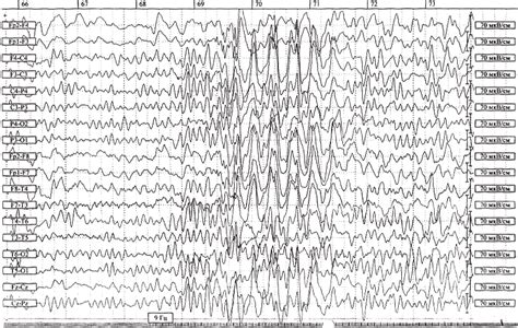 Patient N 23 Years Old еlectroencephalogram Diffuse Asynchronous