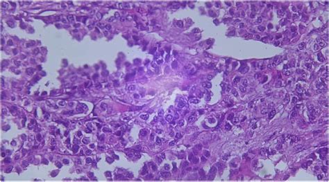 Radiation Induced Breast Angiosarcoma A Case Report International
