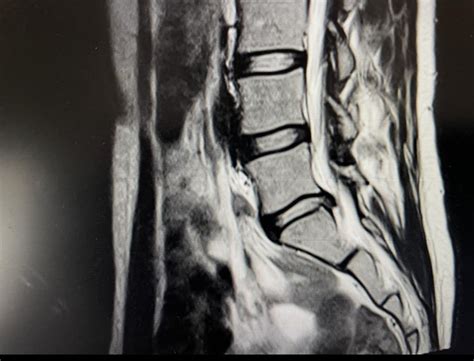 “its Probably Not Your Disc” Rsciatica