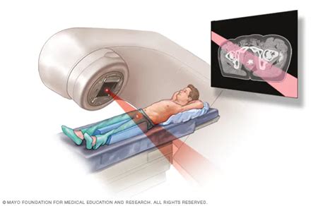 Radiation Therapy For Prostate Cancer Understanding Options Side