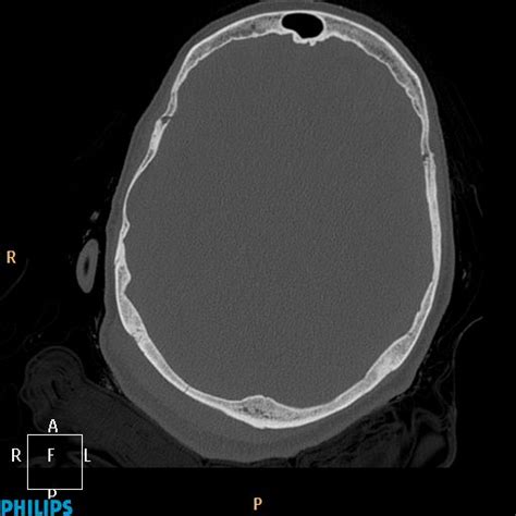 Tdm Non Injecté Coupe Axiale Fenêtre Osseuse