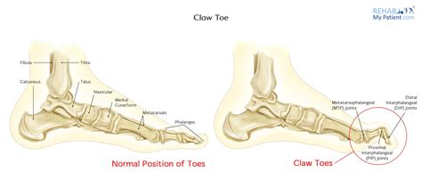 Claw Toe Rehab My Patient