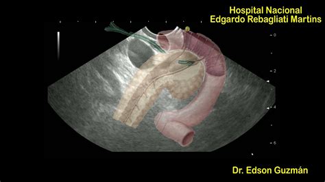 Eus In The Diagnosis Of Distal Cholangiocarcinoma Youtube