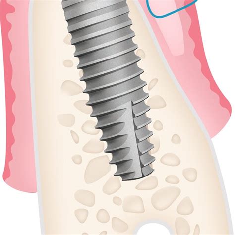 Illustration Of Partial Thickness Flap Group Download Scientific Diagram