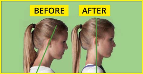Face Forward Posture At Oscar Godson Blog