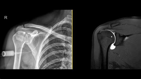 What Is An Mri Shoulder Arthrogram Youtube